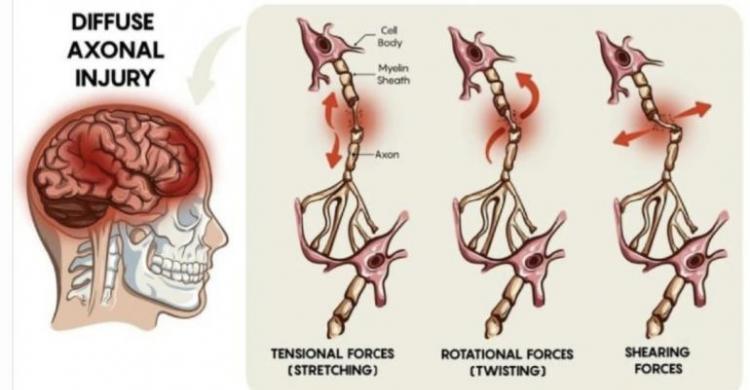 Kritis Dianiaya, Anak Kader GP Ansor Kena Diffuse Axonal Injury, Begini ...