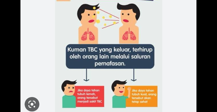 Serem, Deteksi TBC Capai Rekor Tertinggi di 2022